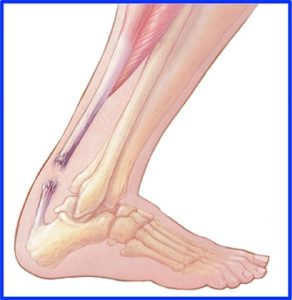 Heel Pain - Activate Physiotherapy